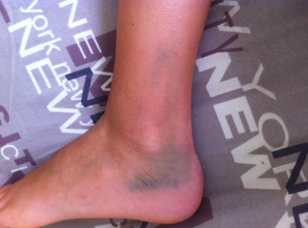 Trail : que faire quand on se tord la cheville ? - u-Trail